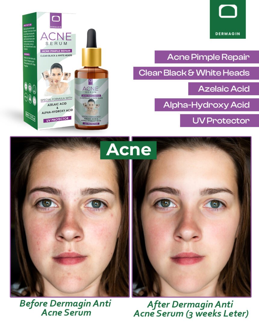 Dermagin Anti Acne Serum With Azelic Acid For Acne Pimple
